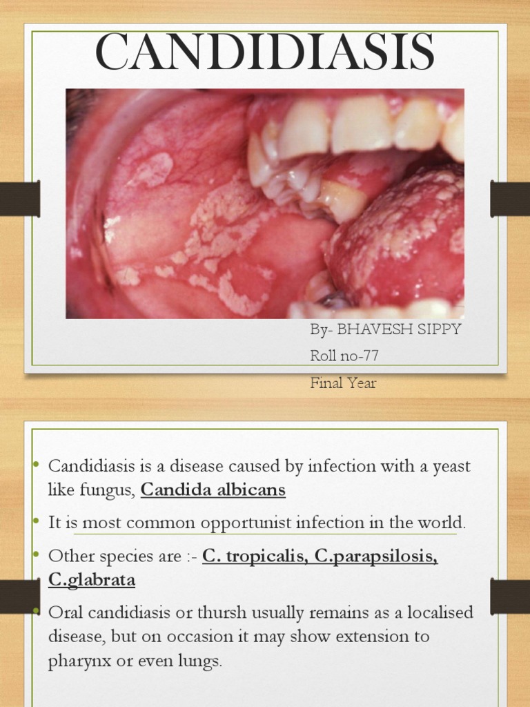 Candidiasis | PDF | Candidiasis | Immunology
