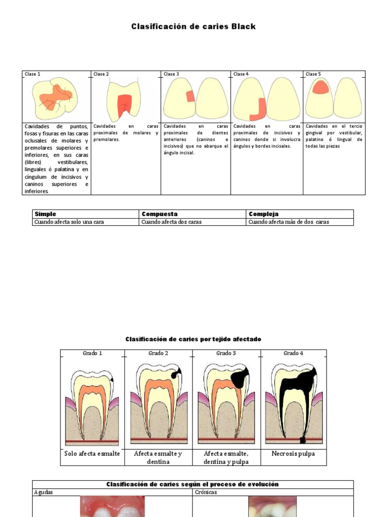 clasificación de caries dental