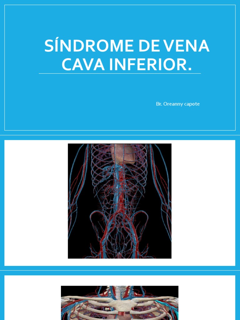 Síndrome de Vena Cava Inferior | PDF Síndrome de Vena Cava Inferior | PDF