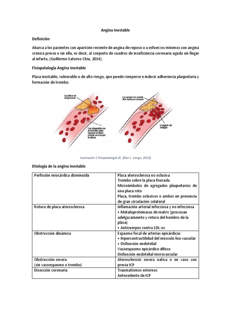 Angina Inestable | Infarto de miocardio | Enfermedades cardiovasculares