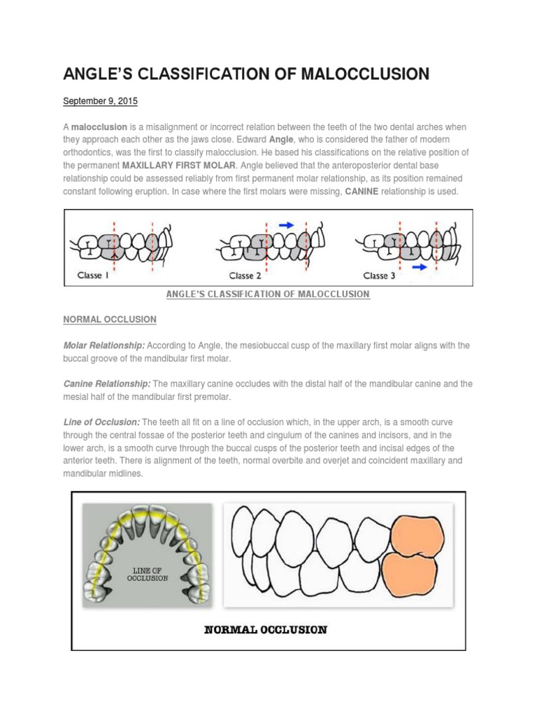 Angle's Classification of Malocclusion | PDF | Mouth | Orthodontics