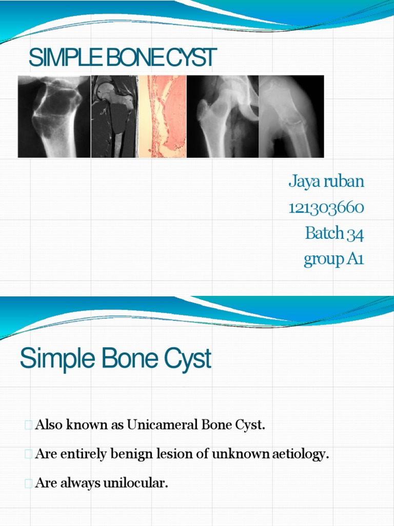 Understanding Simple Bone Cysts | PDF