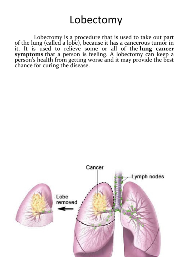 Lobectomy: Symptoms That A Person Is Feeling. A Lobectomy Can Keep A ...