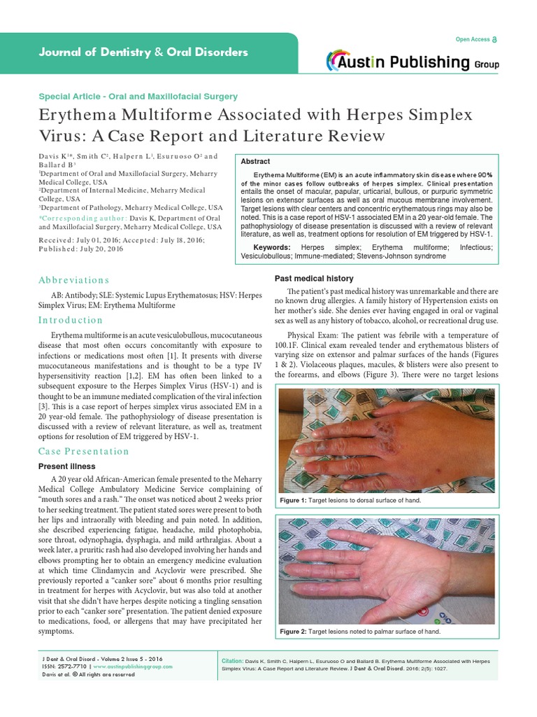 Erythema Multiforme Associated With Herpes Simplex Virus: A Case Report ...