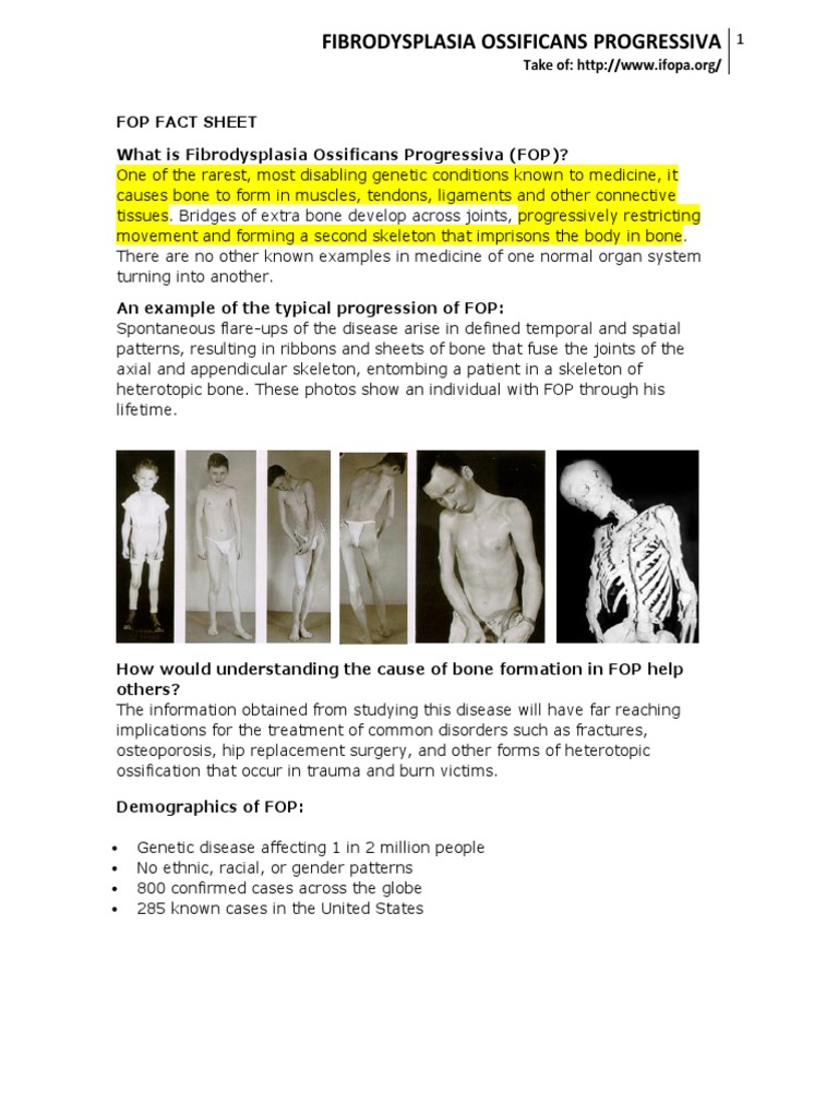 A Comprehensive Overview of Fibrodysplasia Ossificans Progressiva (FOP ...