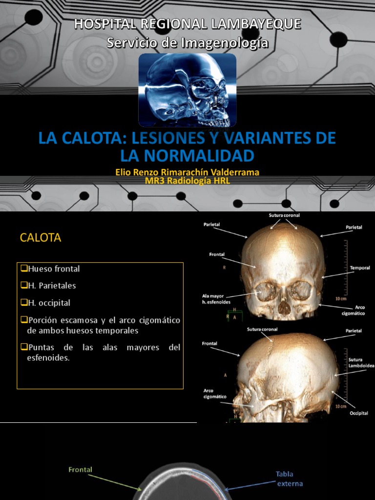 La Calota - Lesiones y Variantes de La Normalidad | PDF | Hueso | Cráneo