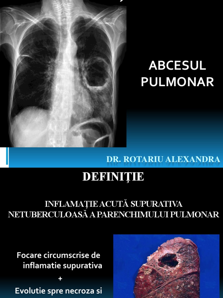 ABCES PULMONAR.pptx