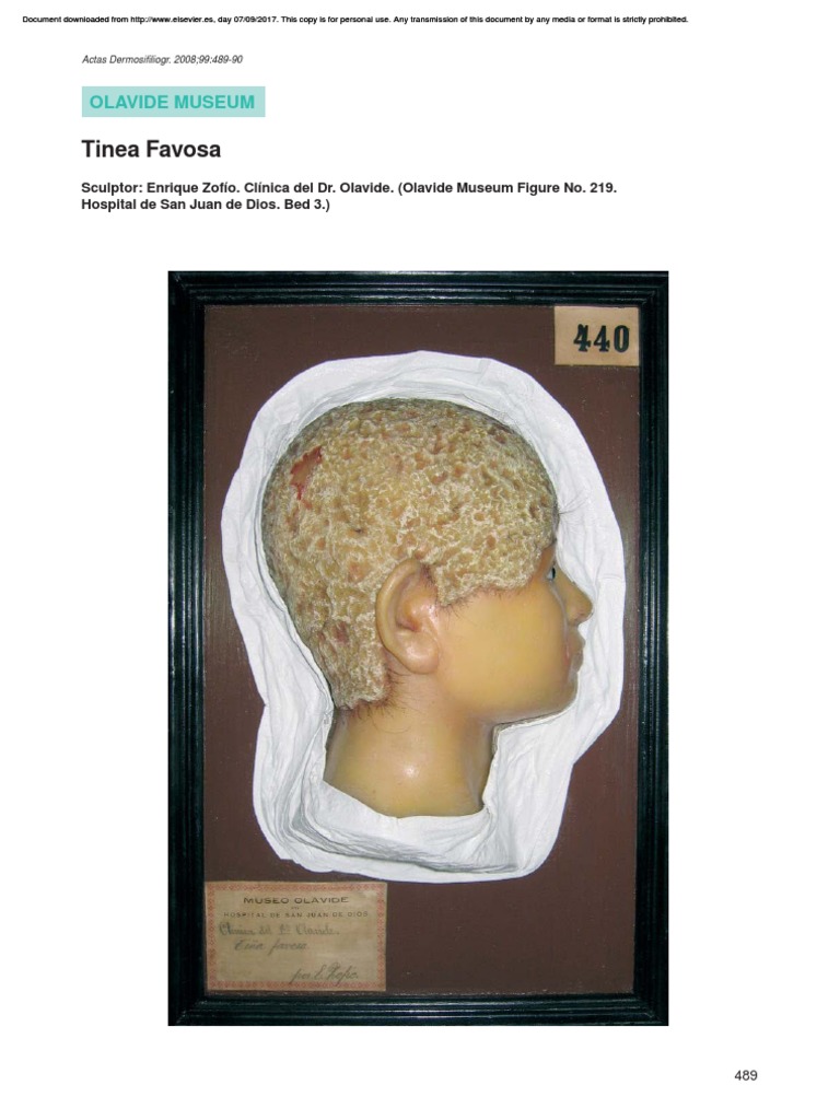 Tinea Favosa: Olavide Museum | PDF | Medicine | Medical Specialties