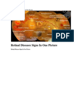 Understanding White Without Pressure (WWOP) | PDF | Vision | Ophthalmology