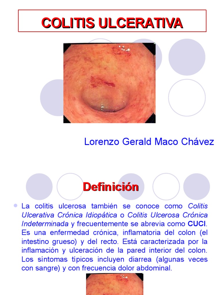 Colitis Ulcerativa