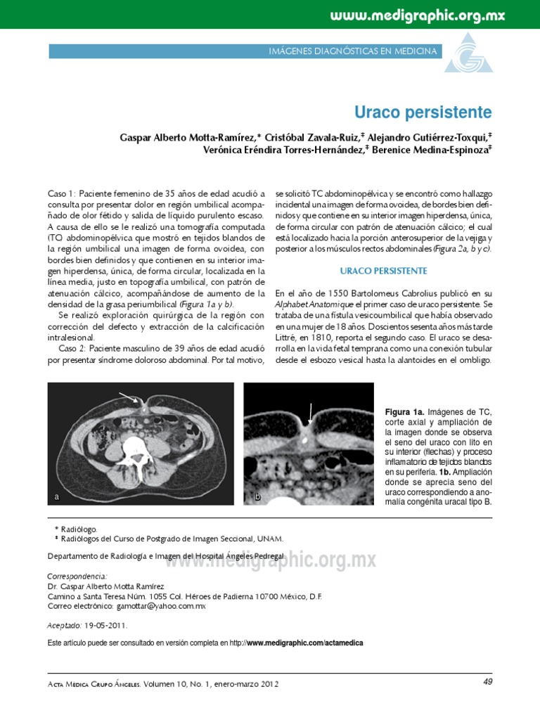 Uraco Persistente | PDF | Ct Scan | Vejiga urinaria