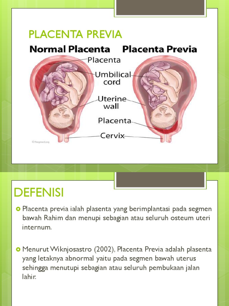 Plasenta Previa | PDF