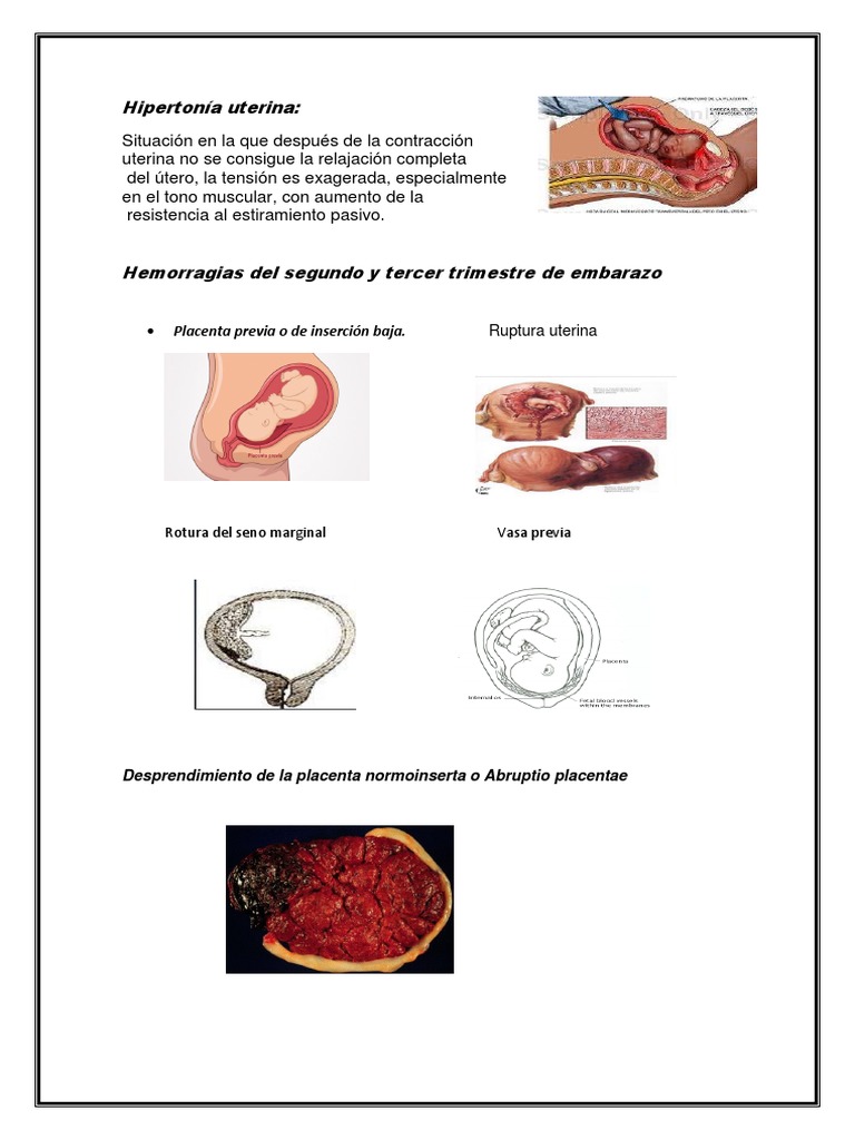 Hipertonía Uterina | Contracción muscular | Medicina
