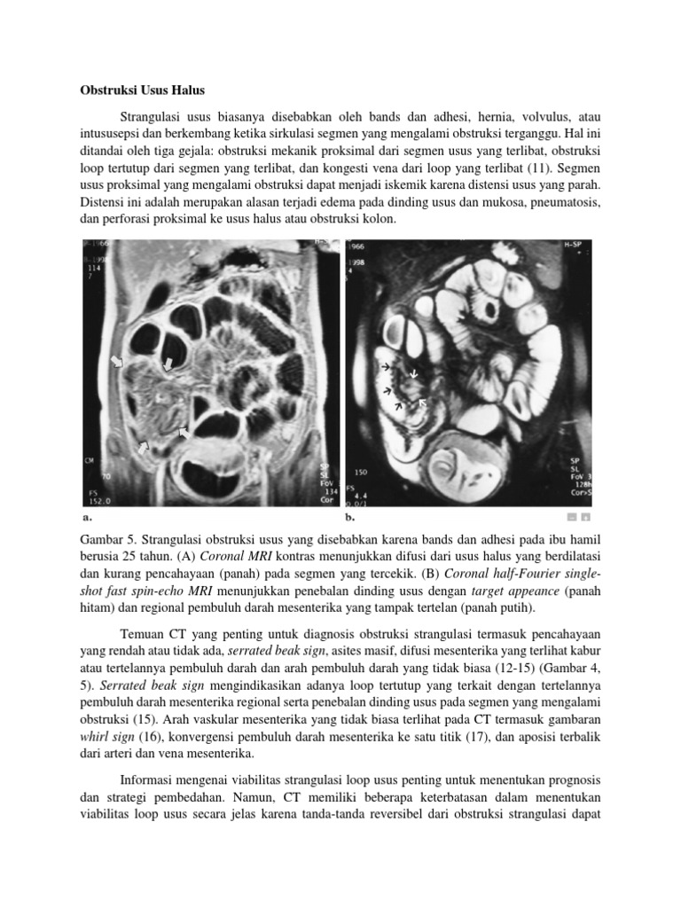 Obstruksi Usus Usus Pencekikan Biasanya Disebabkan Oleh Ikatan Dan ...