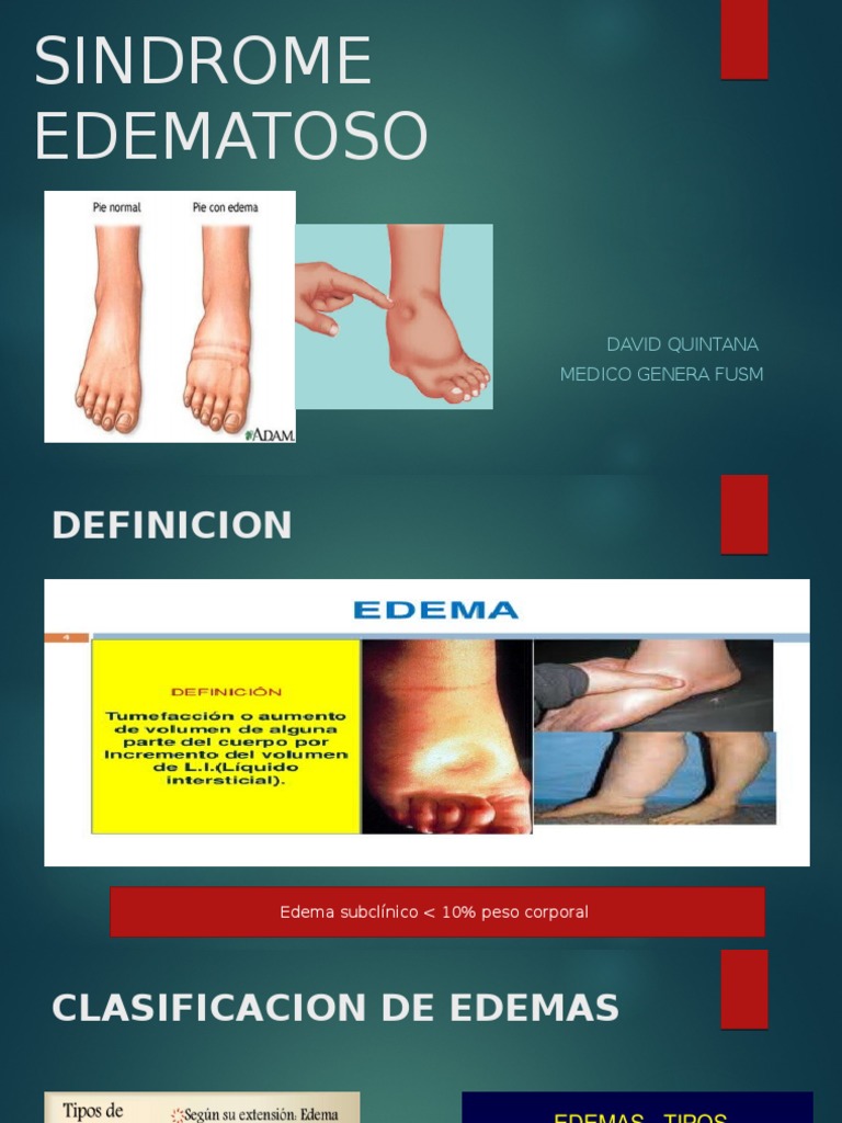 SINDROME EDEMATOSO | Edema | Especialidades Medicas