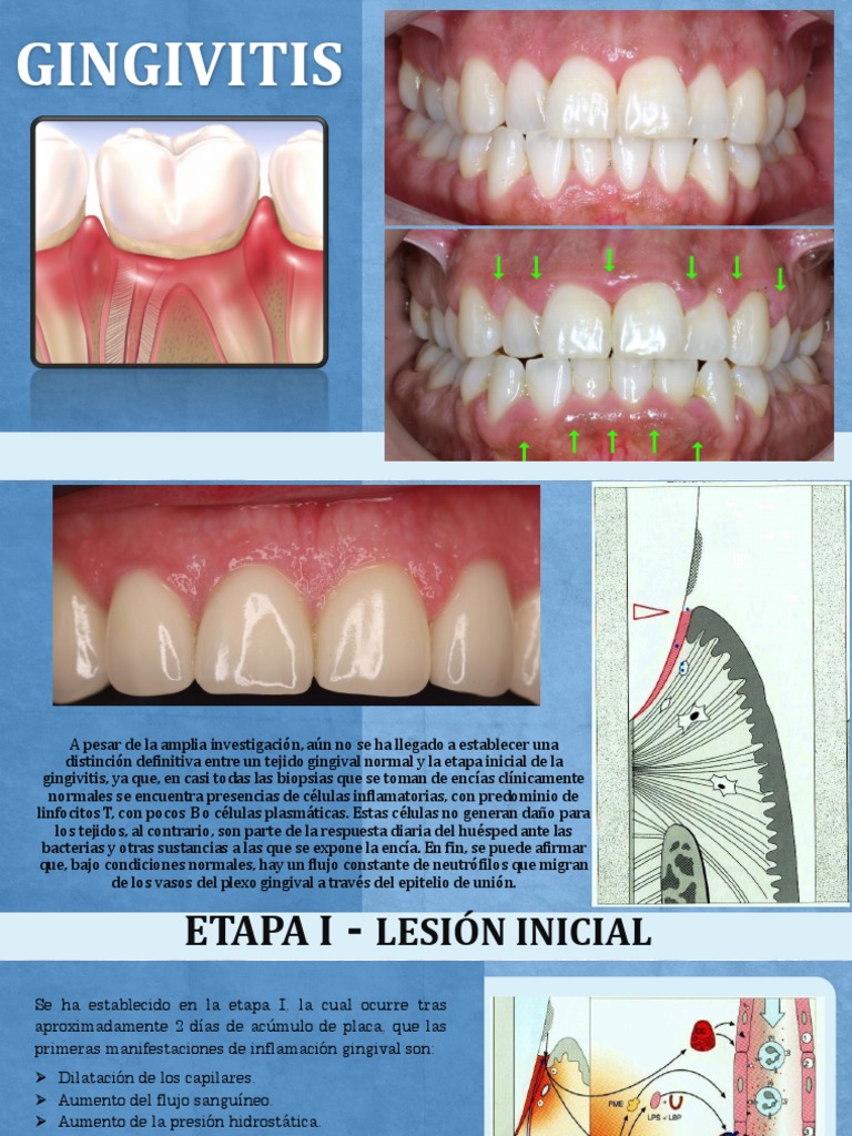 Capítulo 21 Inflamación Gingival. | Inflamación | Anatomía