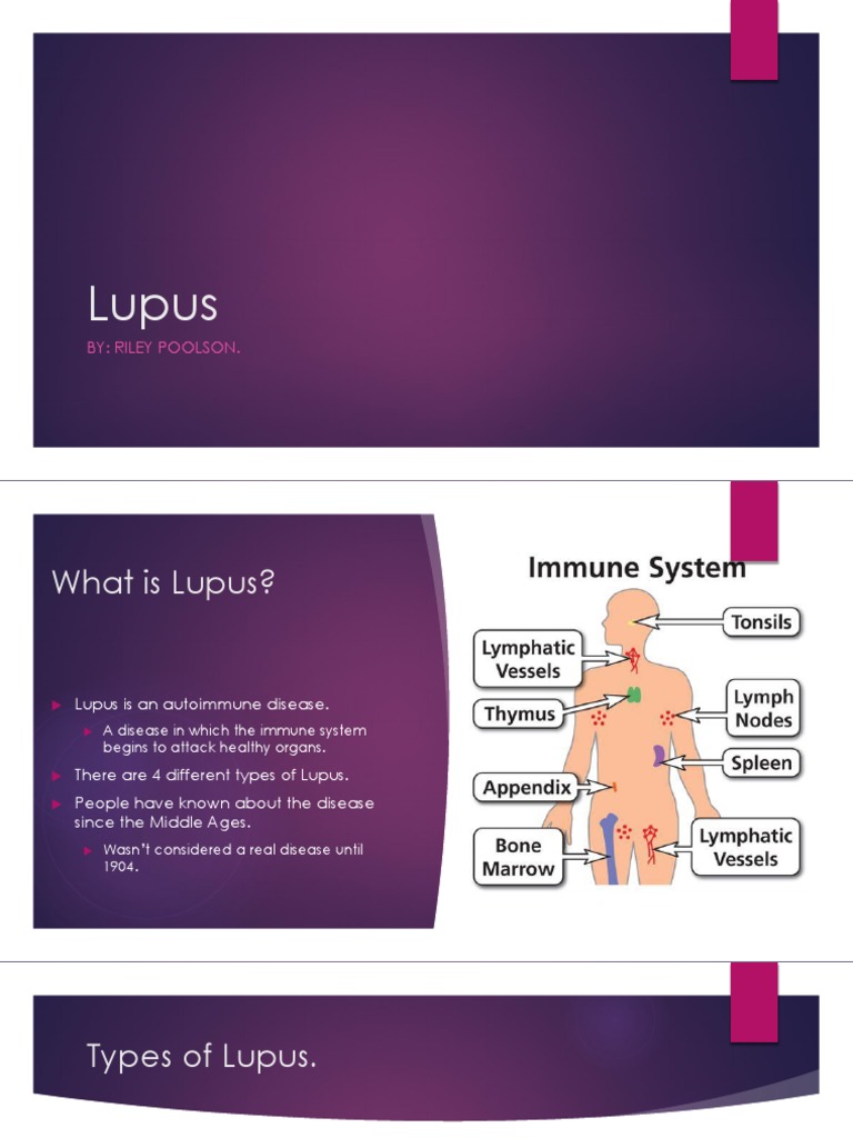 Lupuspresnetation | PDF | Systemic Lupus Erythematosus | Rtt