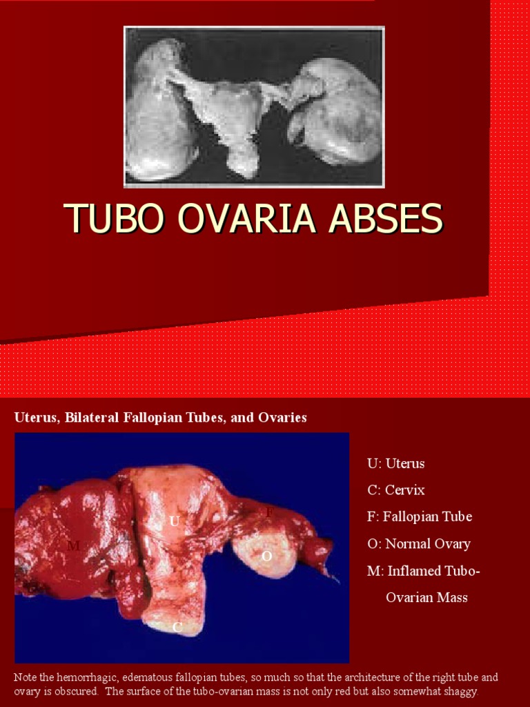 Inflamed Fallopian Tubes Abcess | PDF