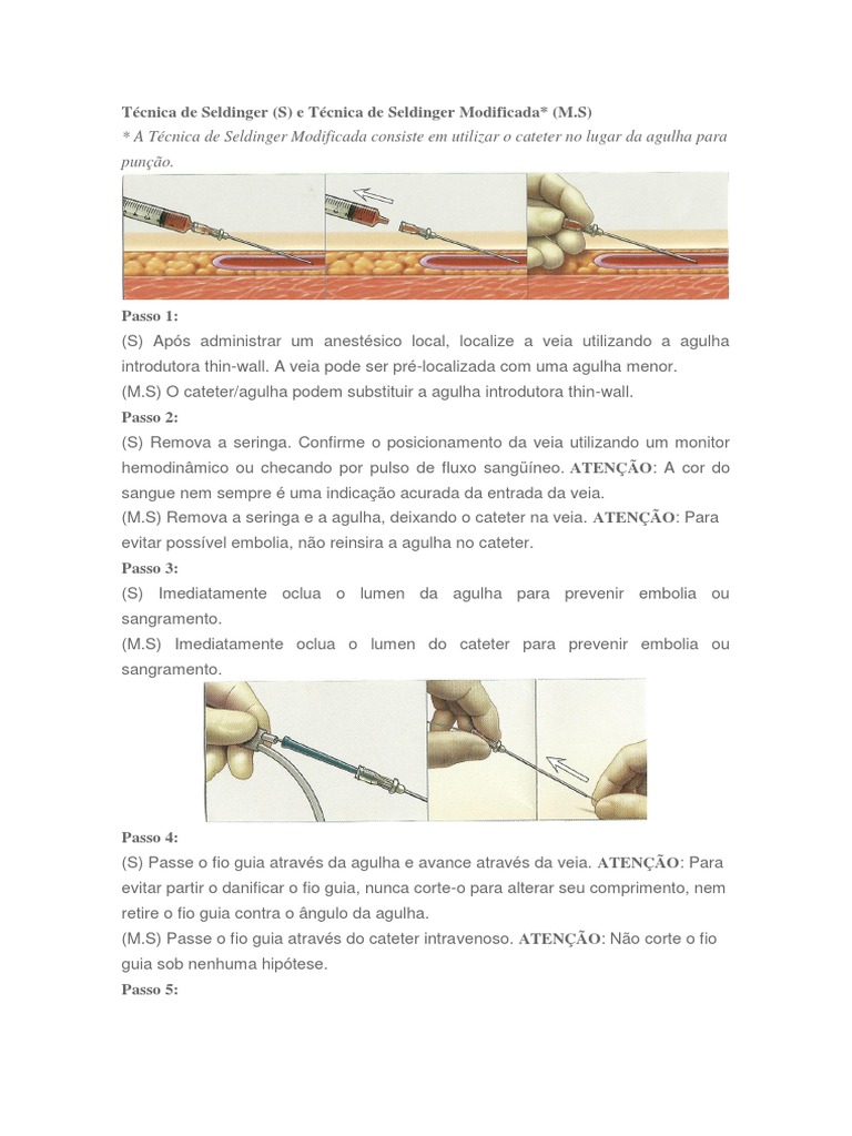 Técnica de Seldinger