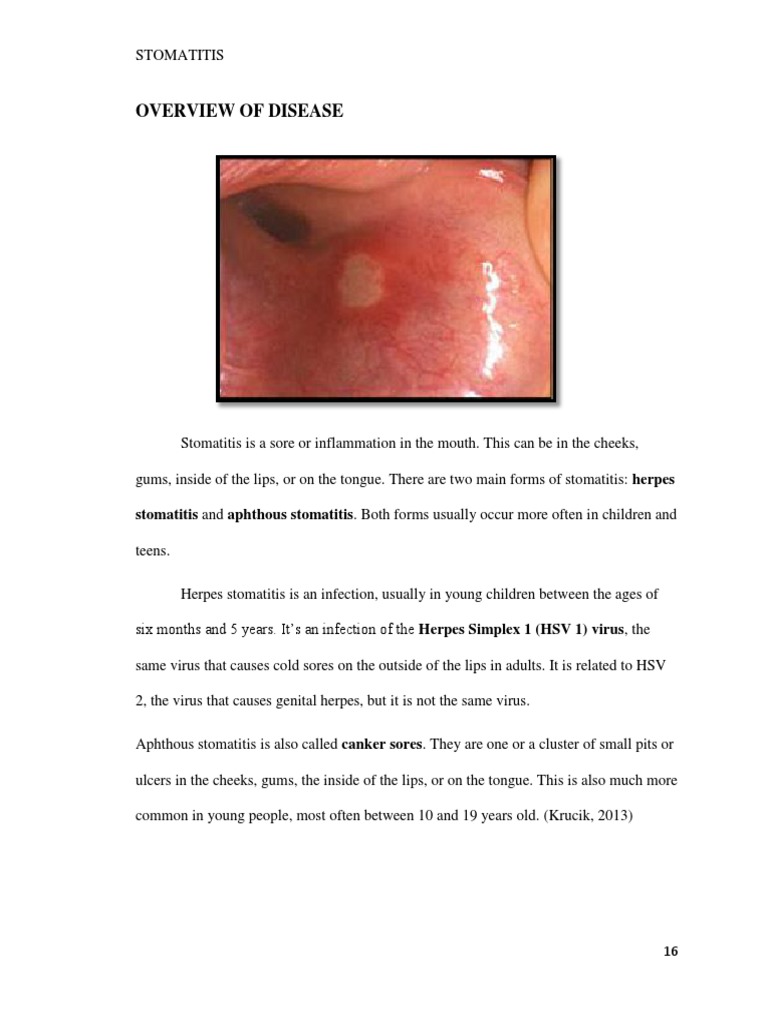 STOMATITIS | PDF | Herpes Simplex | Mouth