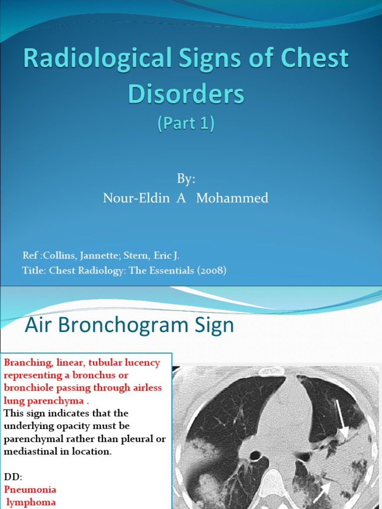Radio Logical Chest Signs | Download Free PDF | Lung | Pulmonology