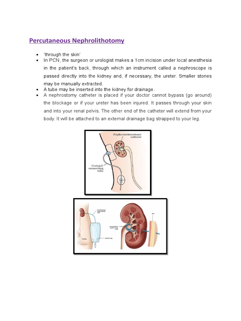 Percutaneous Nephrolithotomy Overview | PDF