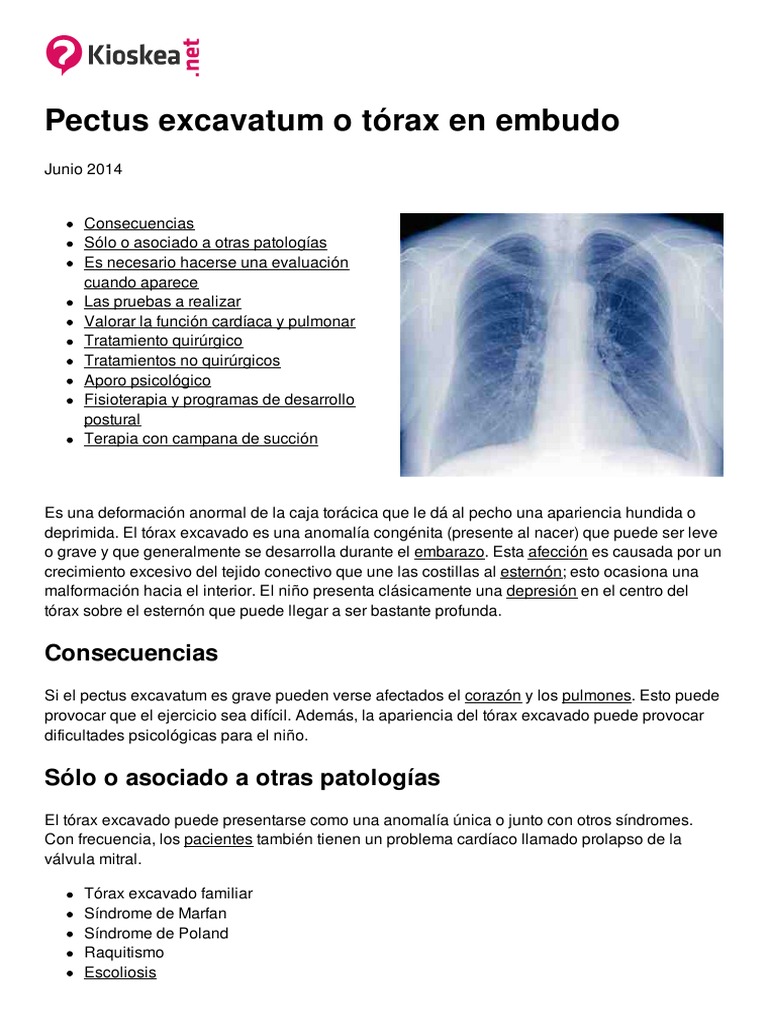 Pectus Excavatum o Torax en Embudo 14218 Mw5mzr | PDF | Tórax ...