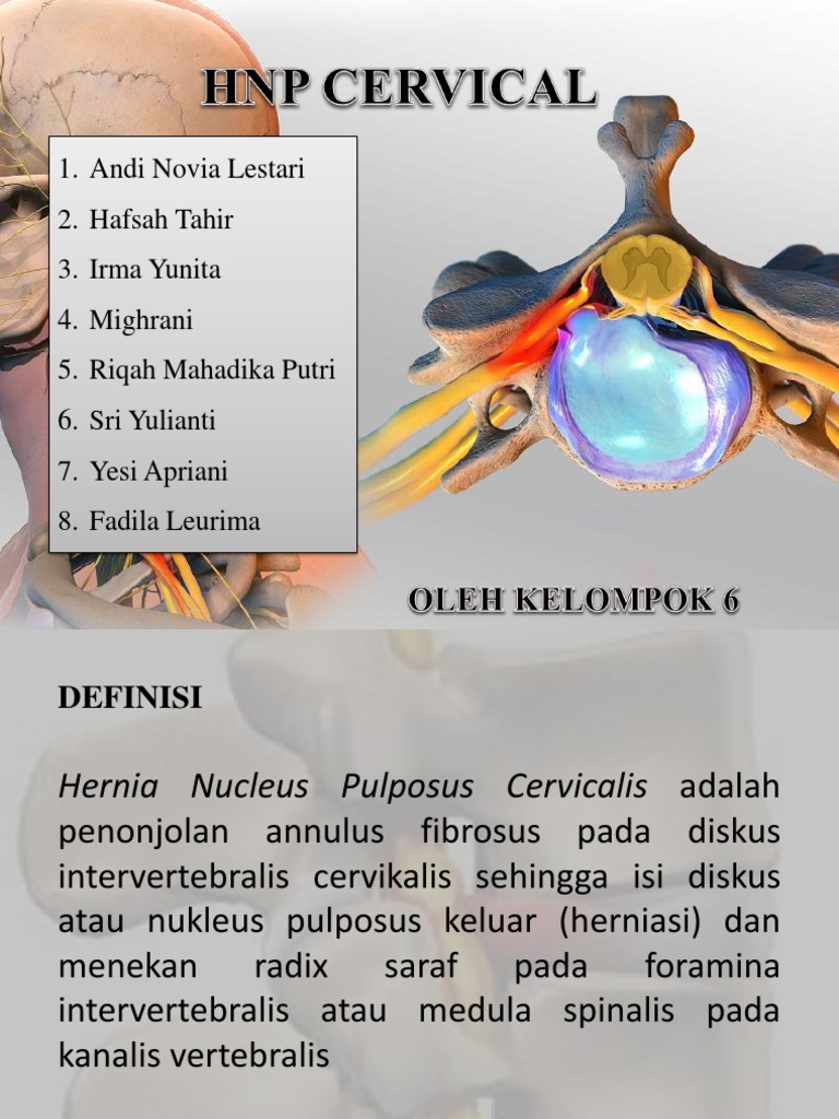 HNP Cervical | PDF