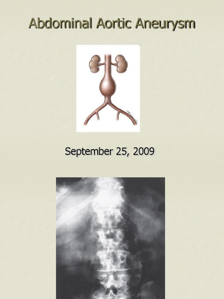 Abdominal Aortic Aneurysm 2 | PDF | Vascular Diseases | Cardiovascular ...