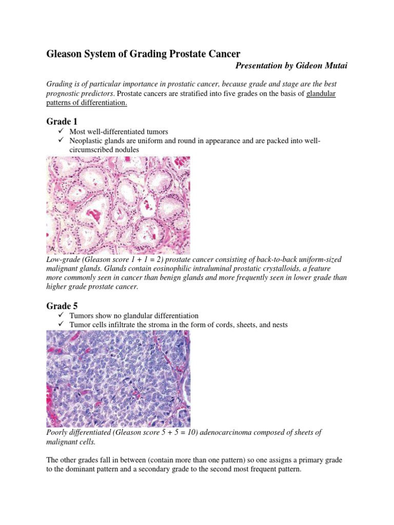 Gleason System of Grading Prostate Cancer | Medicine | Clinical Medicine