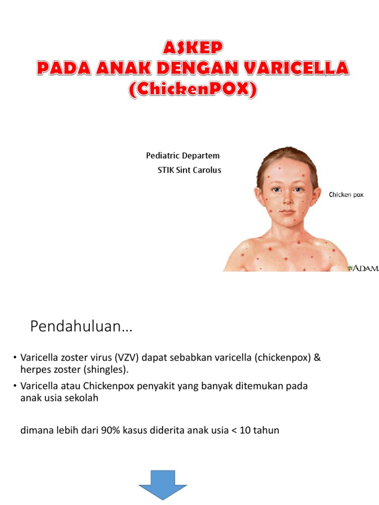Varicella | PDF