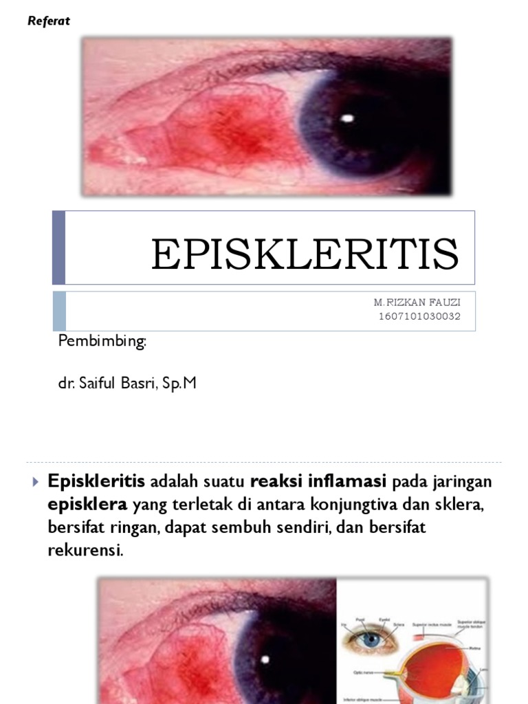 EPISKLERITIS | PDF | Sains & Matematika