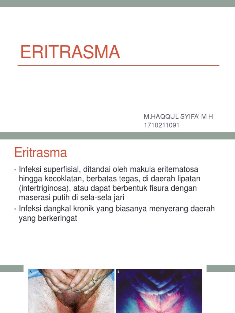 Eritrasma | PDF