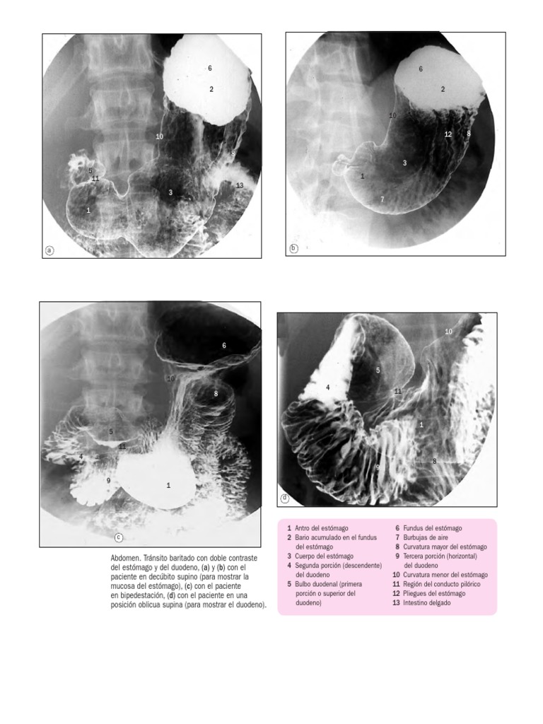 RX Con Sin Medio de Contraste de Colon Estomago y RX de Abdomen | PDF ...