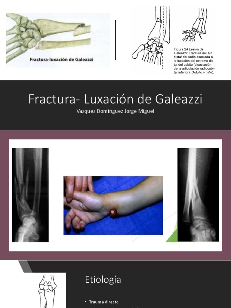 Fractura-Luxación de Galeazzi: Guía Clínica | PDF