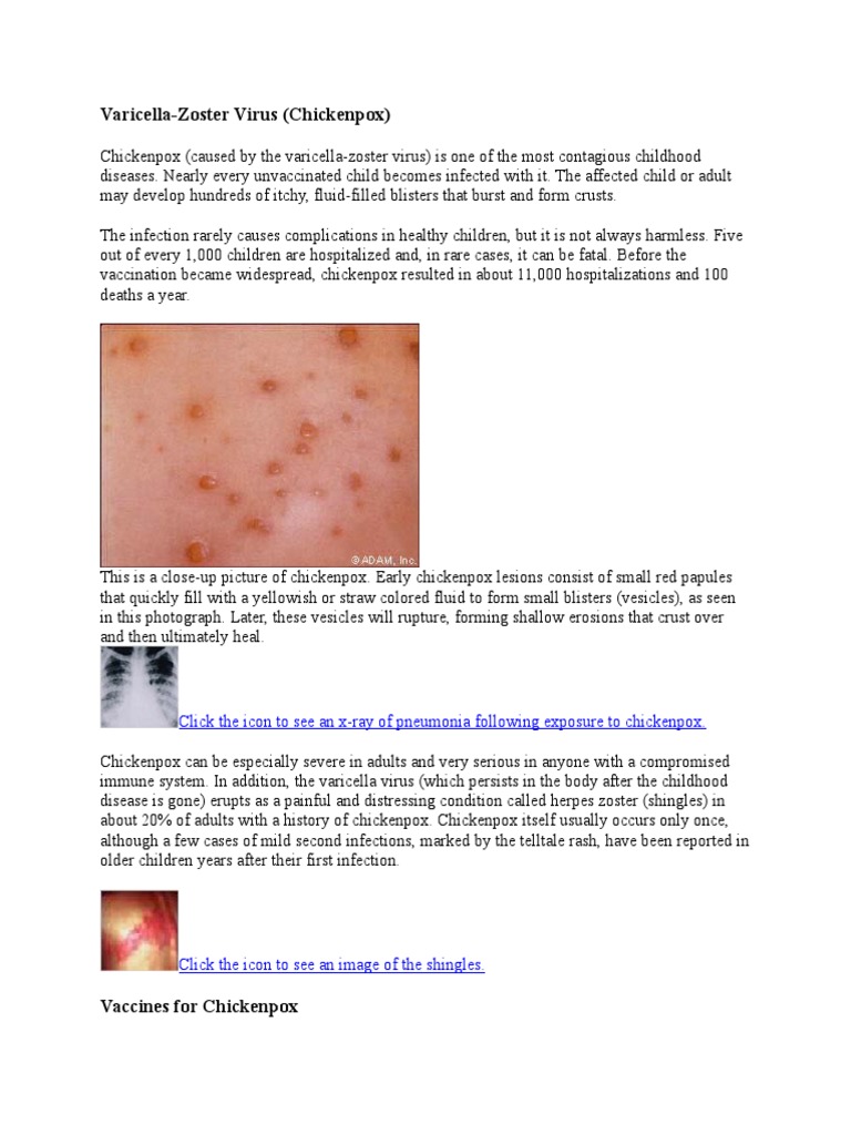 Varicella-Zoster Virus (Chickenpox) : Click The Icon To See An X-Ray of ...
