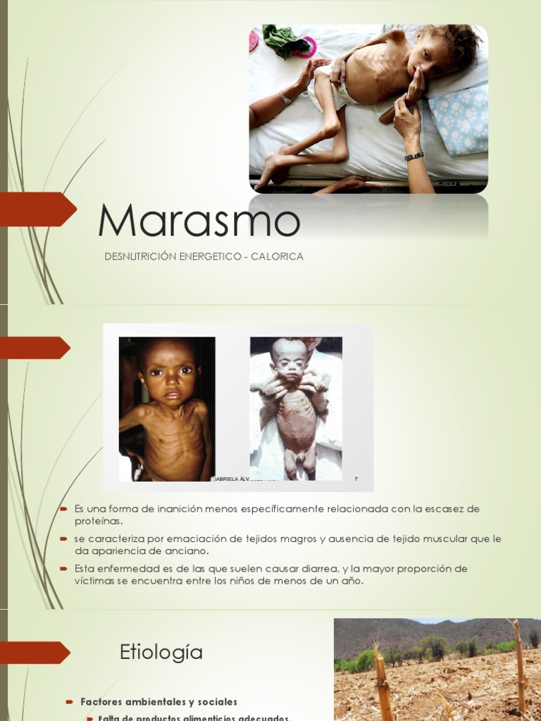Marasmo | PDF | Índice de masa corporal | Diarrea