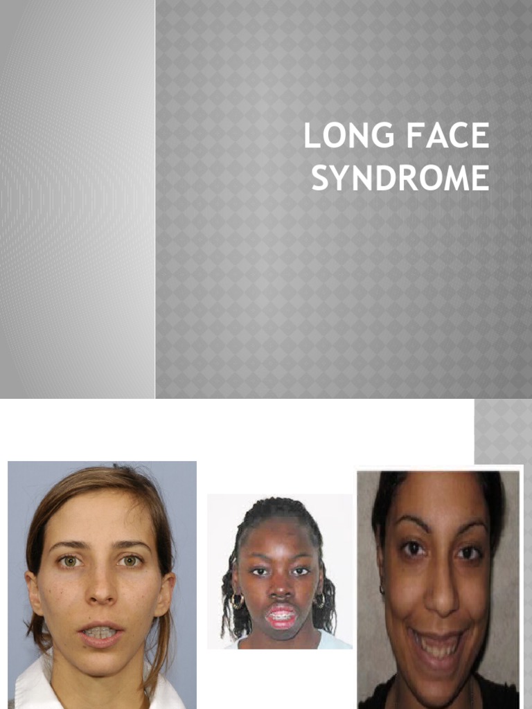 Long Face Syndrome