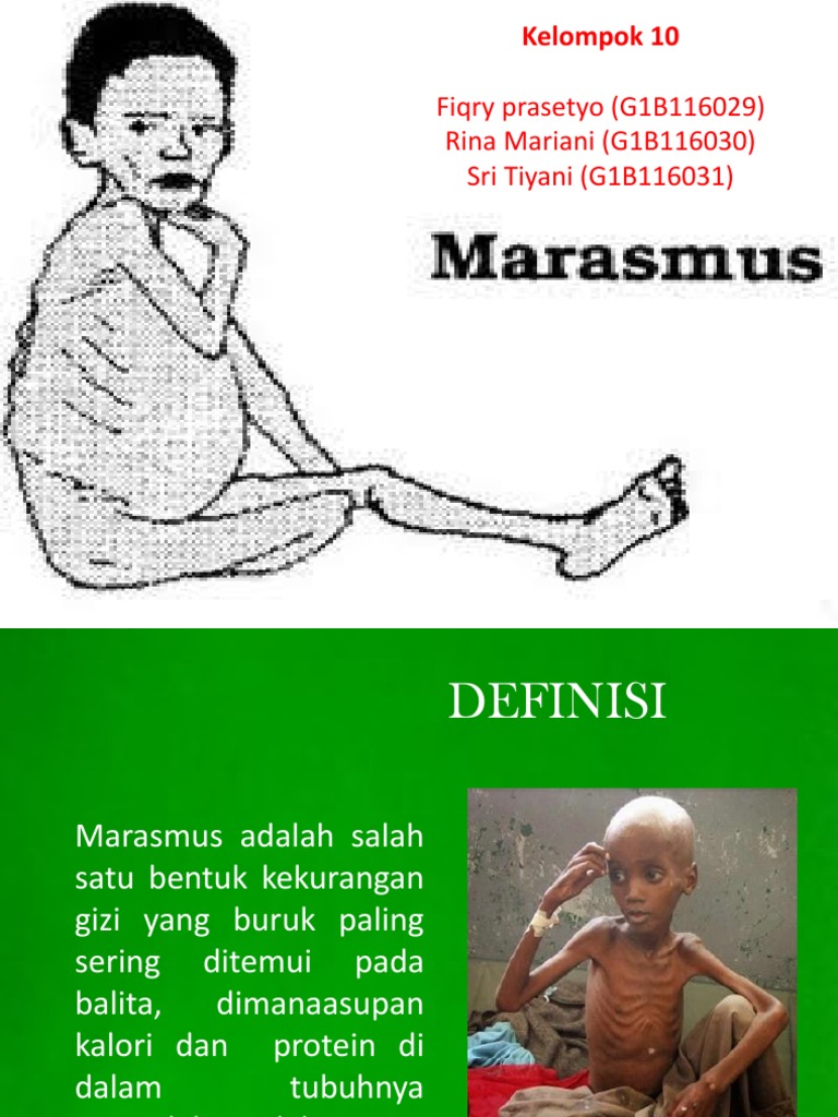 Penyakit Marasmus | PDF