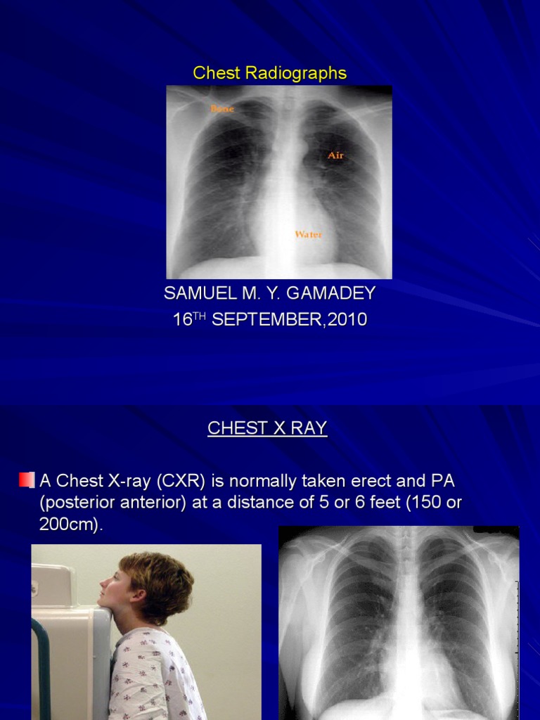 Apical Lordotic Chest X-Ray Overview | PDF | Lung | Thorax (Human Anatomy)