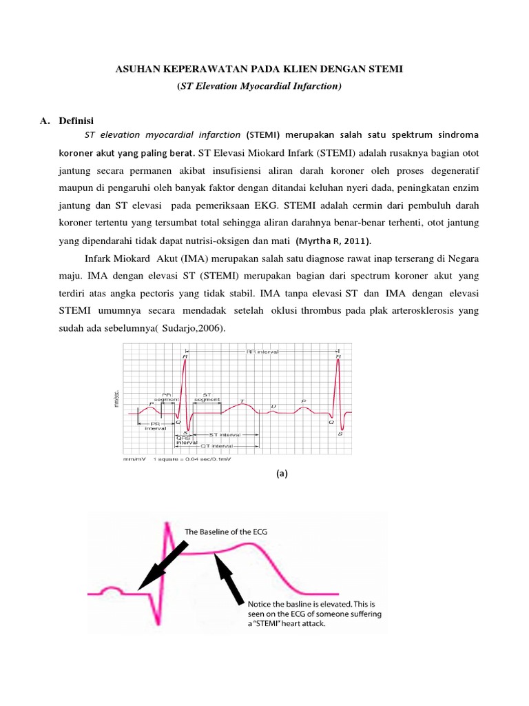 Laporan Pendahuluan STEMI | PDF