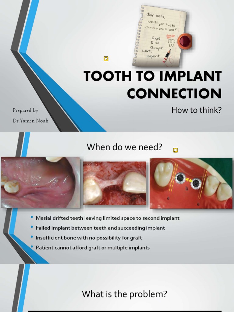 Tooth To Implant Connection | PDF | Dental Implant | Dentistry Branches