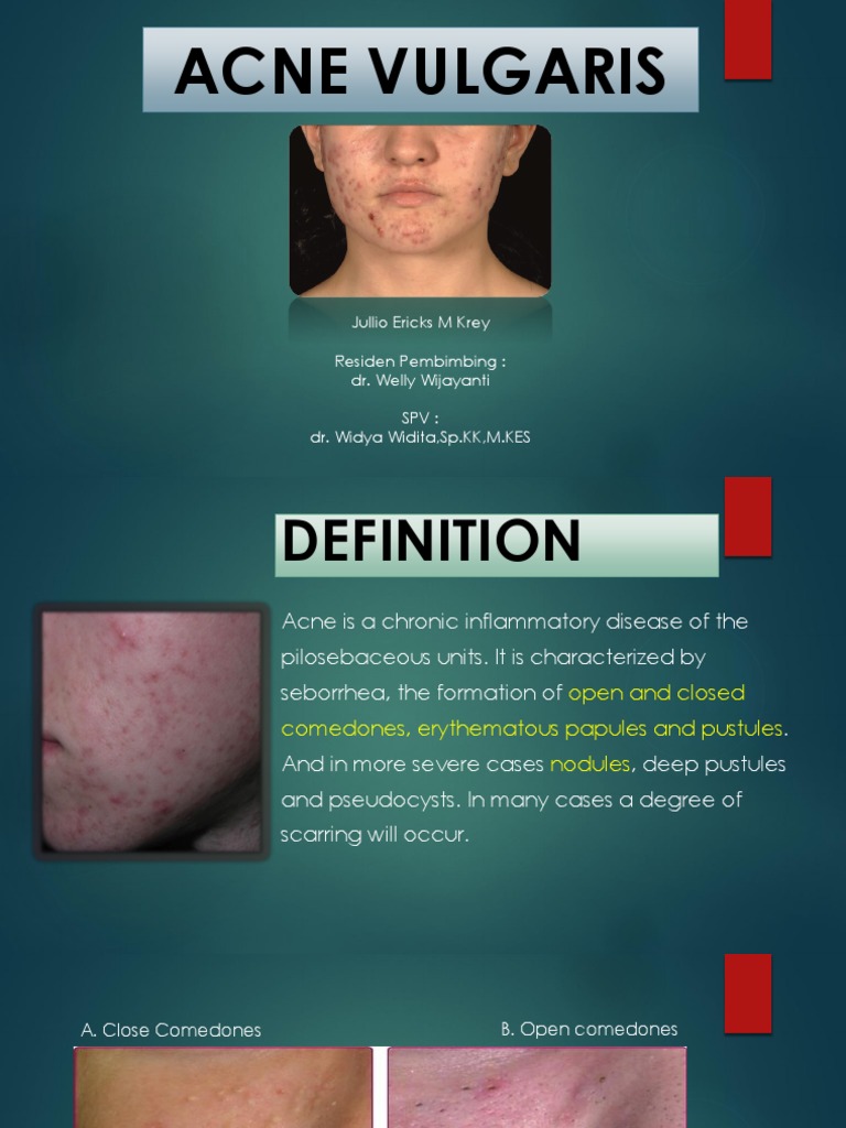 Acne Vulgaris Powerpoint | PDF | Health Sciences | Dermatology