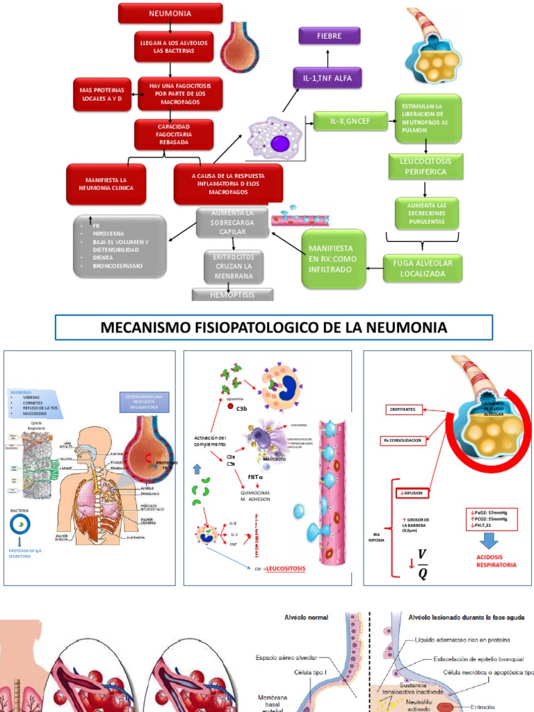 Neumonia | Inflamación | Neumonía