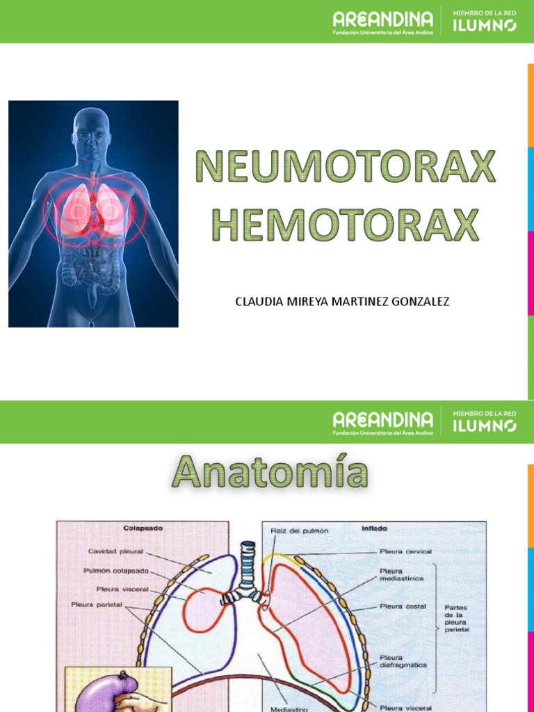 Diapositivas Neomotorax | PDF | Pulmón | Especialidades Medicas