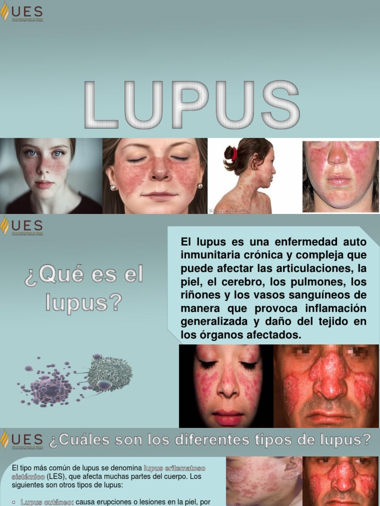 Lupus | PDF | Lupus eritematoso sistémico | Corazón
