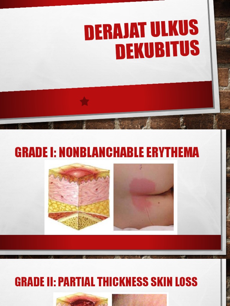 1 Derajat Ulkus Dekubitus | PDF