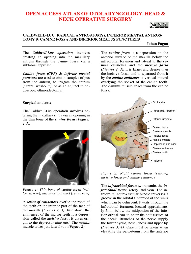 Caldwell Luc _radical Antrostomy_ Procedure Canine Fossa and Inferior ...