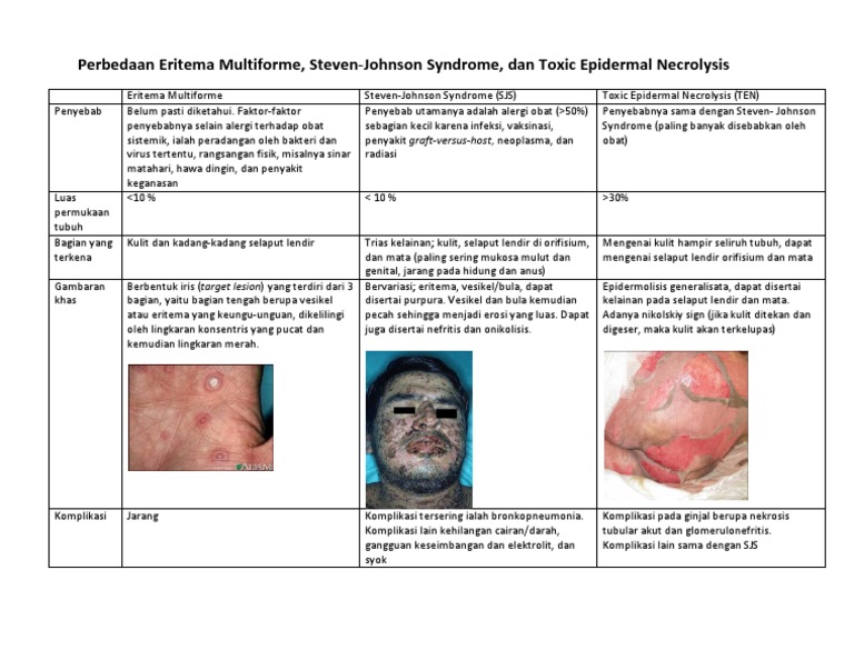 Perbedaan Eritema Multiforme SJS TEN | PDF