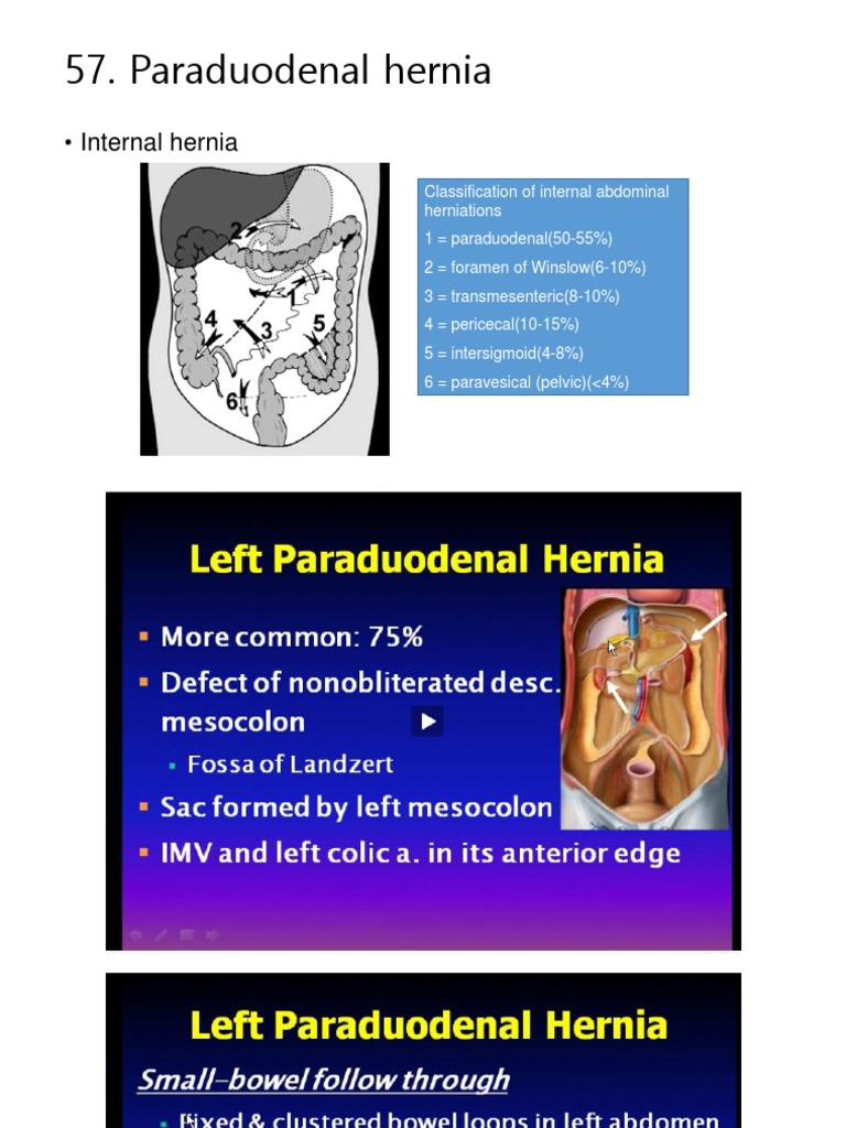 Paraduodenal Hernia | PDF | Self-Improvement | Wellness